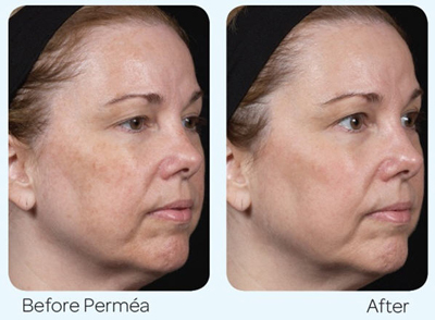 Clear and Brilliant Permea – Dr. Paul Cohen – Rosedale Dermatology Centre